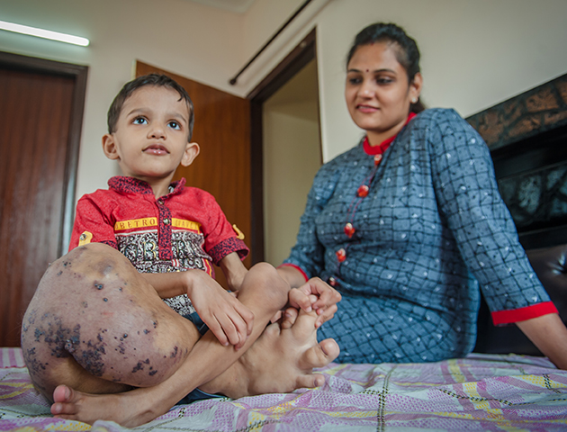 Boy with Klippel-Trenaunay syndrome has one giant leg