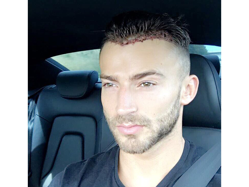 X Factor's Jake Quickenden reveals £5k hair transplant 'after insecurities'