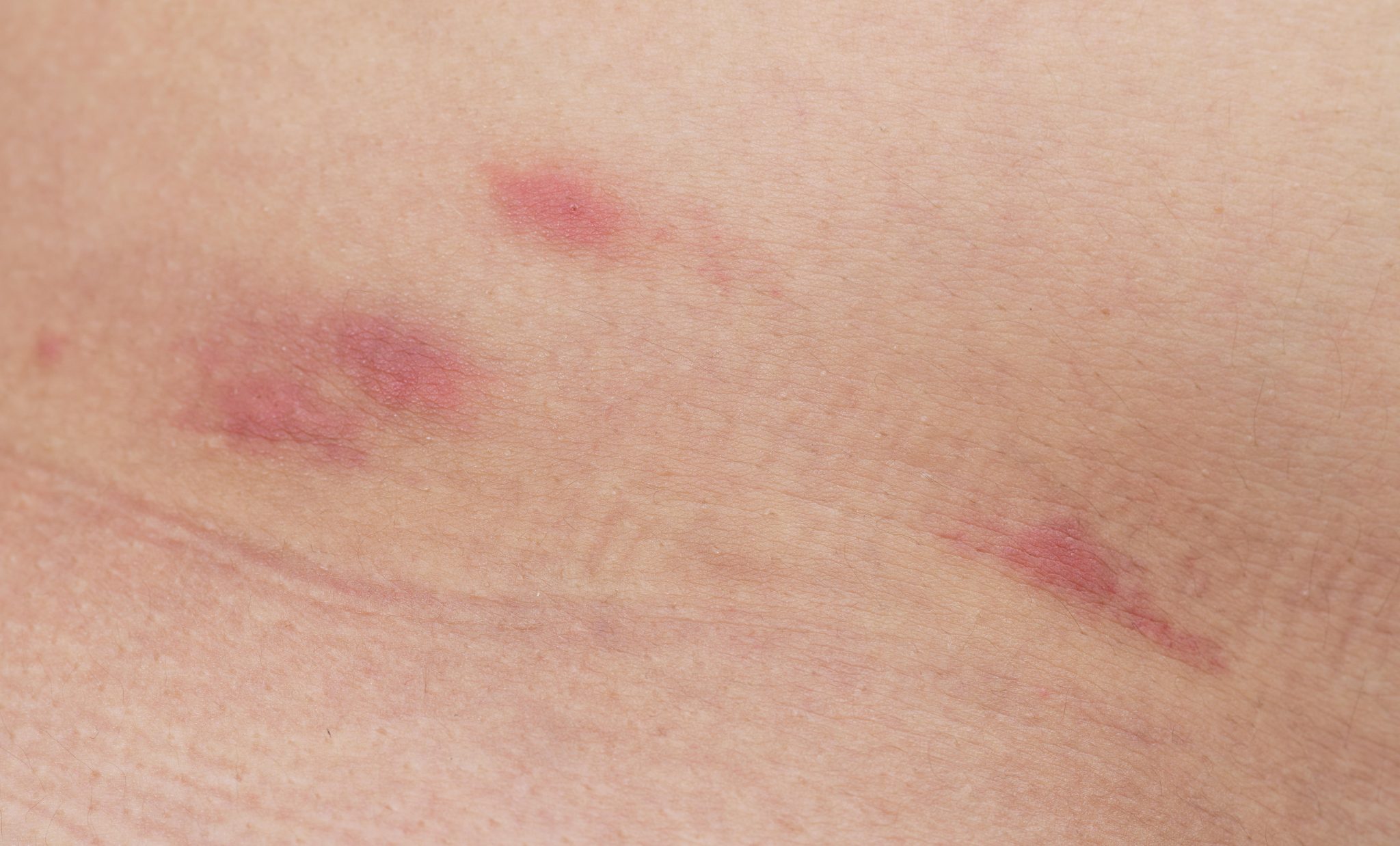 Insect bites treatment: How to treat insect bites in children and adults