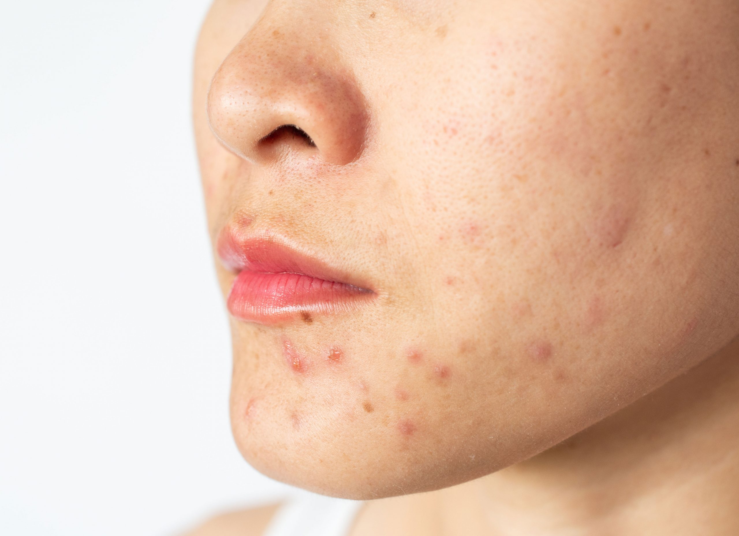 How To Get Rid Of Spots And What Spots On Different Areas Of Your Face Mean How To Get Rid Of Spots And What Spots On Different Areas Of Your Face Mean